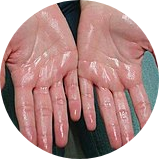 Hyperhidrosis - Foley Dermatology