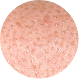 Rough, spiky skin - Foley Dermatology