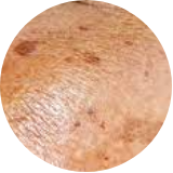Sun-damaged Skin - Foley Dermatology